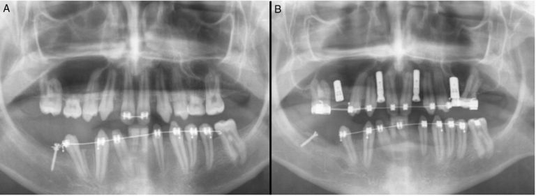 Agenesia dental: Qué es, consecuencias y cómo tratarla
